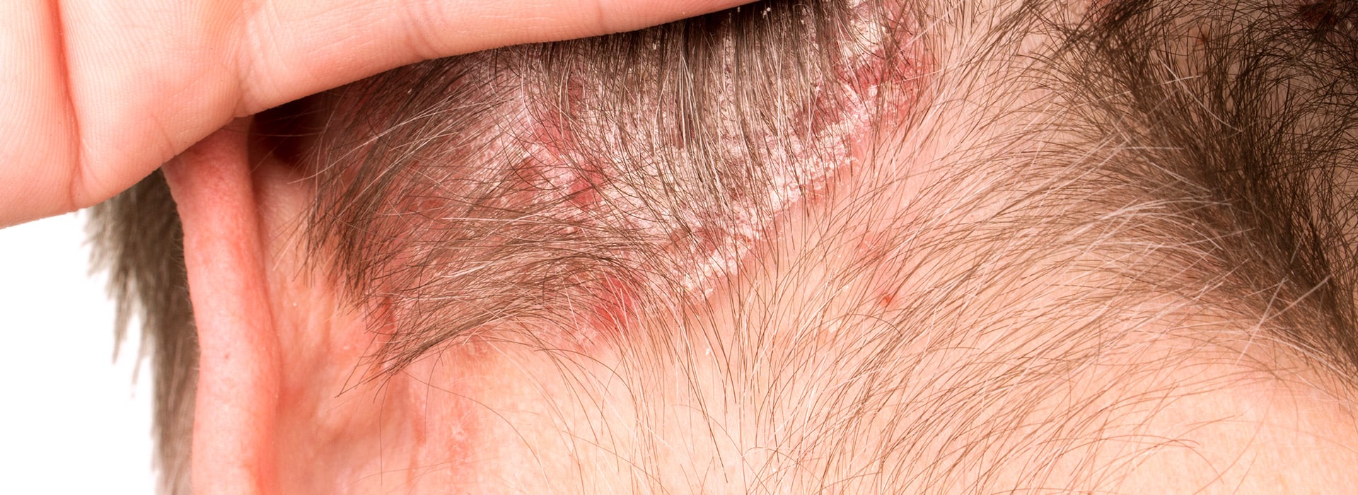 Schuppenflechte / Psoriasis - Scin Center Cassel